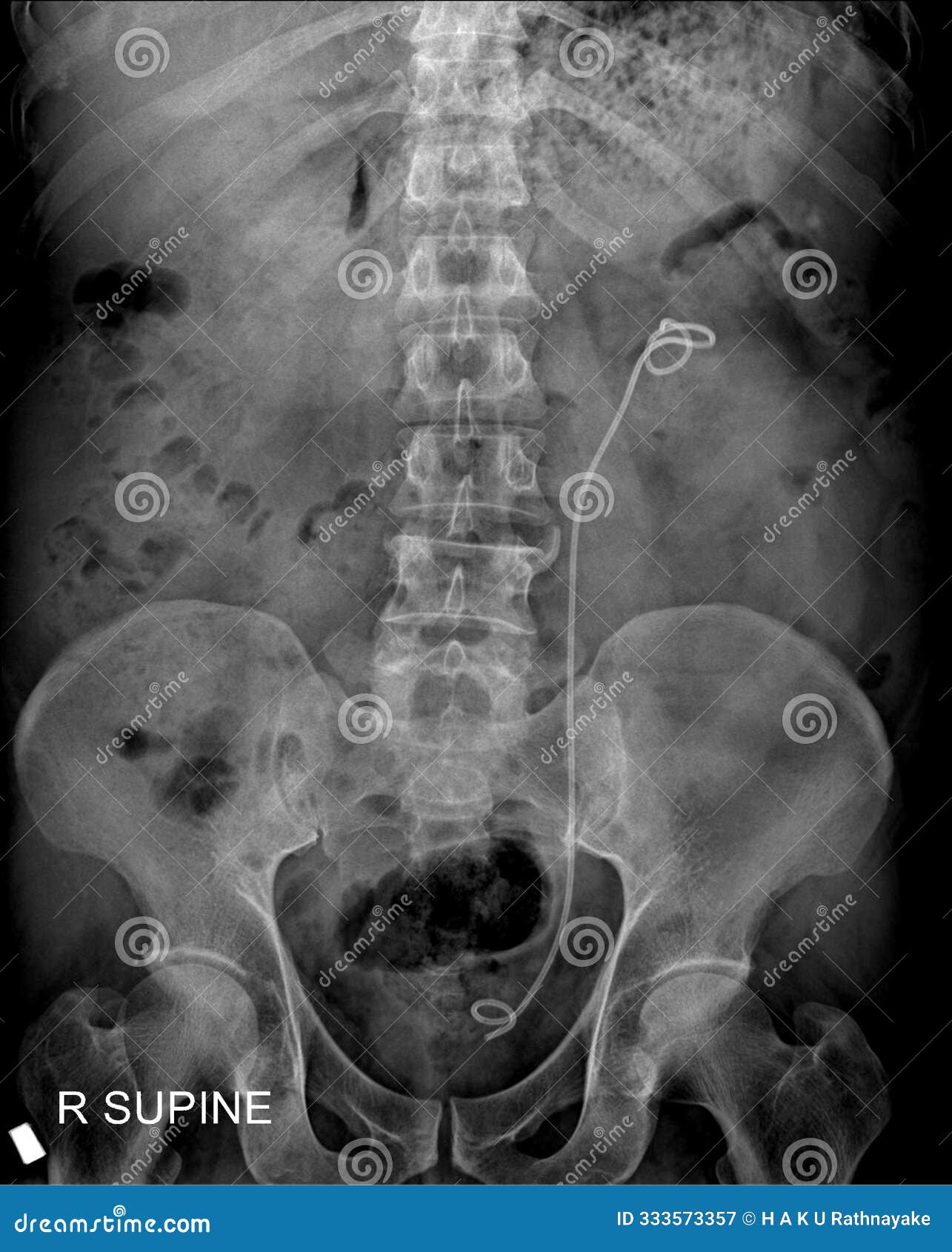 KUB X-ray Imaging with Stent Placement: Precise Radiographic Analysis ...
