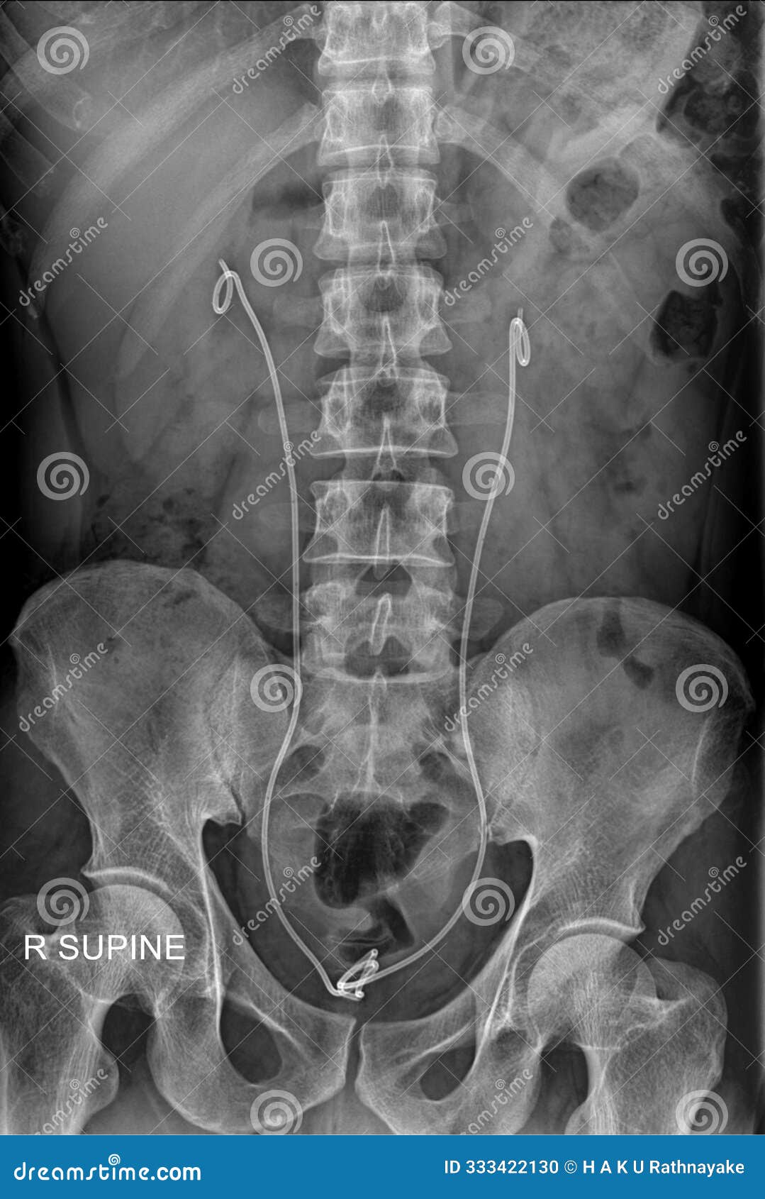 KUB X-Ray: Visualization of Left-Sided Double J Stent from Kidney To ...