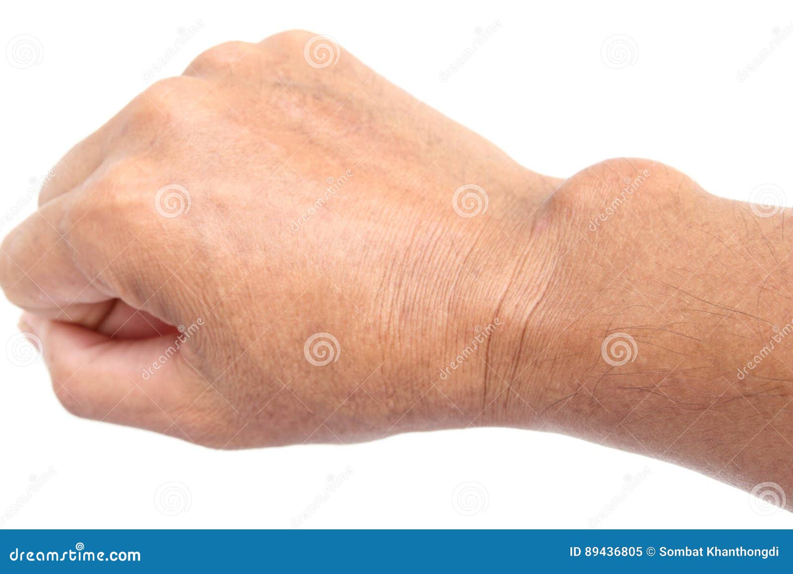 Kyste sur une main image stock. Image du main, ganglion - 89436805