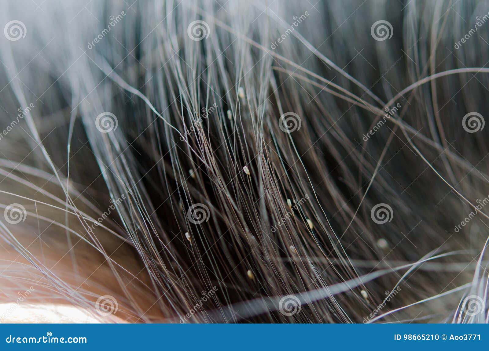 Läuse auf dem Haar stockfoto. Bild von extrem, eier, medizinisch - 98665210