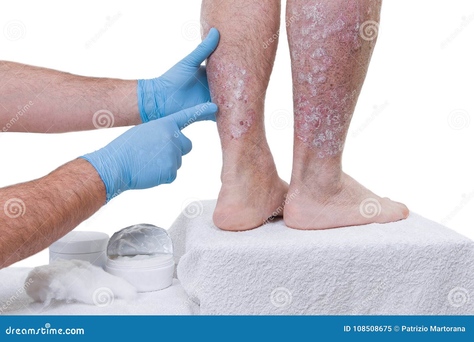 Lésions Cutanées De Psoriasis Image stock - Image du allergie, immunisé ...