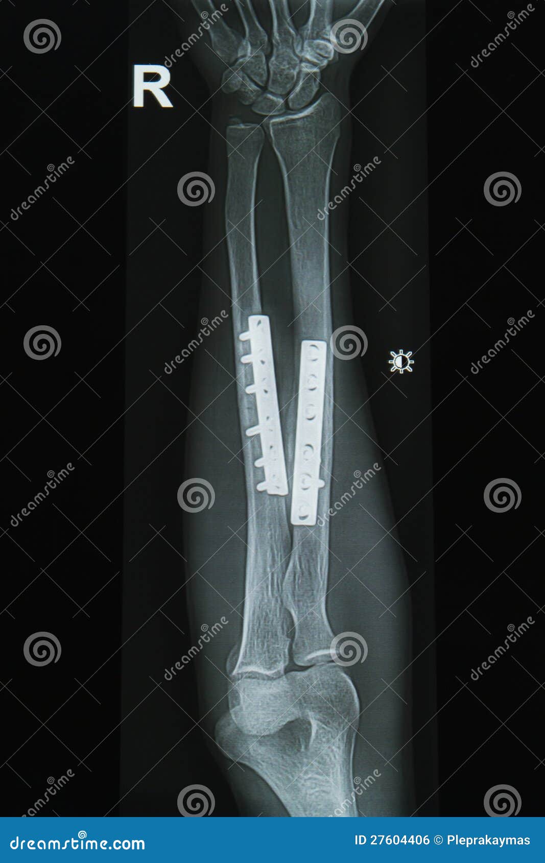 L'avant-bras De Blessures Radiographie L'image Photo stock - Image du ...