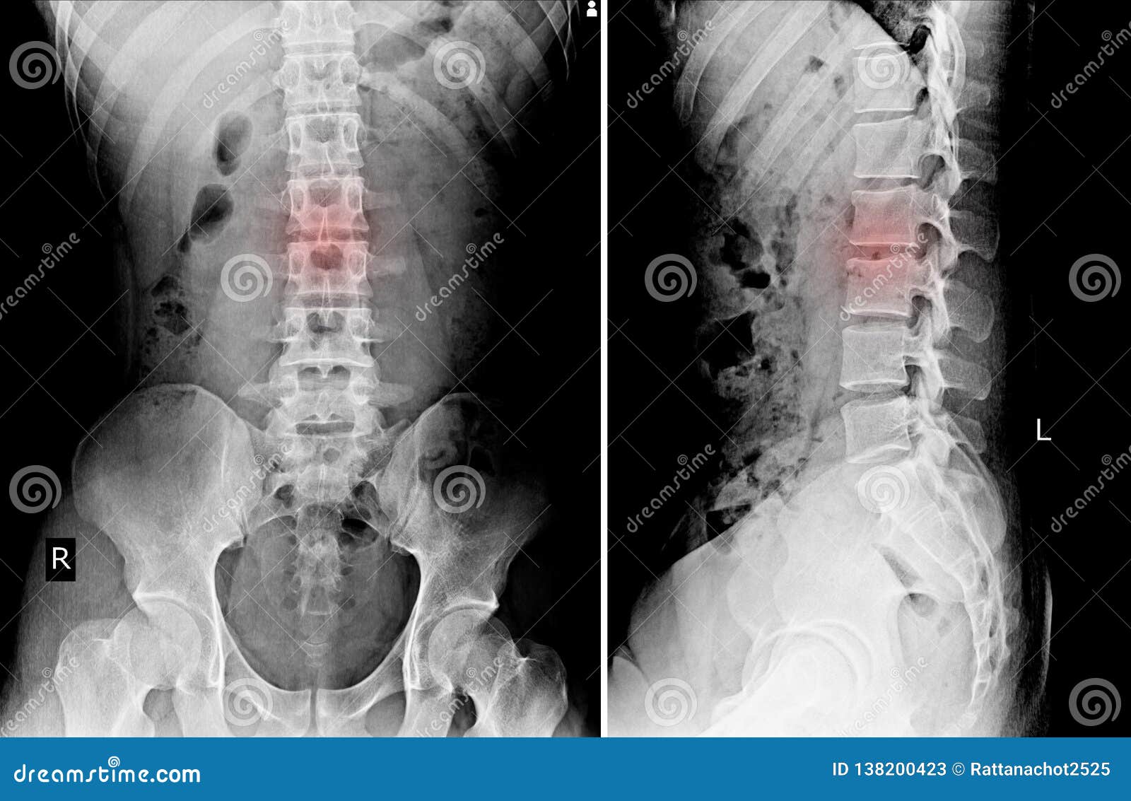 L-S AP SpineLumbo-SACRO Lateral Imagen de archivo - Imagen de nervio ...