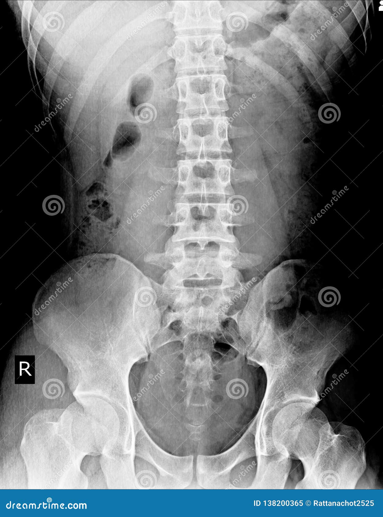 L-S SpineLumbo-SACRAL AP fotografering för bildbyråer. Bild av medicin ...