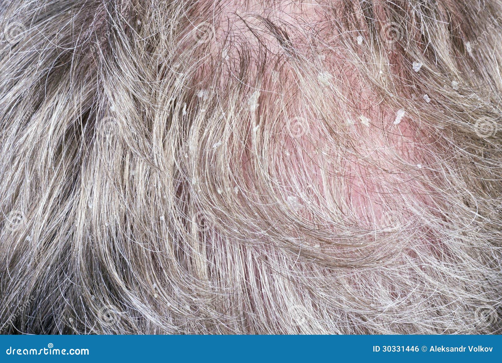 La caspa y se queda calvo foto de archivo. Imagen de hombre - 30331446