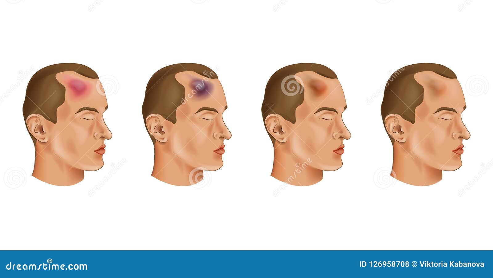 Contusion Stock Illustrations, Vecteurs, & Clipart – (2,132 Stock ...