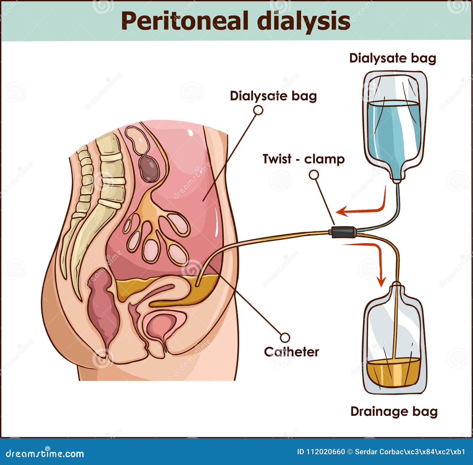La Diálisis Peritoneal Ambas Se Utiliza Para Tratar El Riñón - Vector El Illus Ilustración del ...