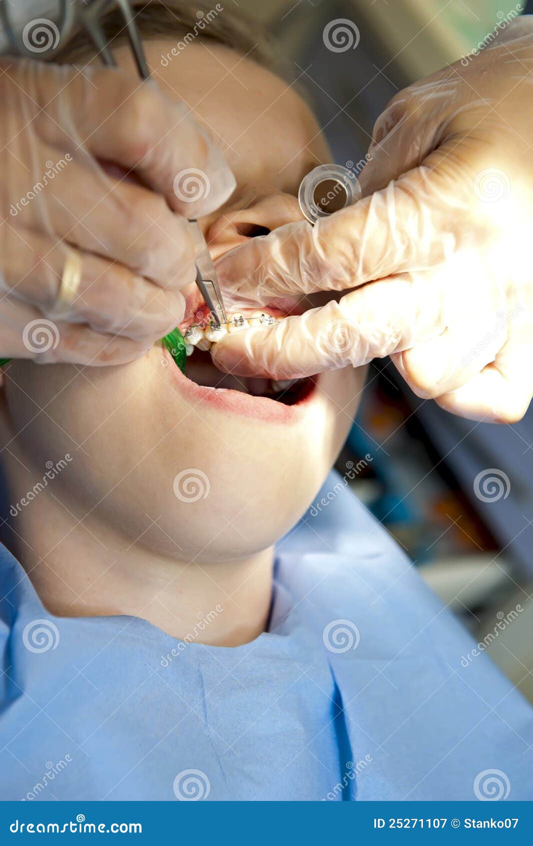 La Instalación De La Paréntesis Imagen de archivo - Imagen de cara ...