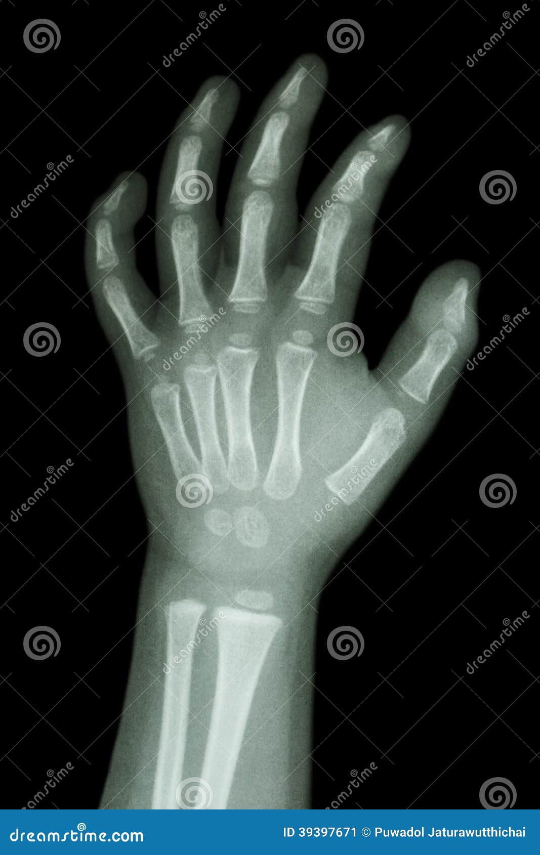 La Main Du Nourrisson De Rayon X Image stock - Image du métacarpienne ...