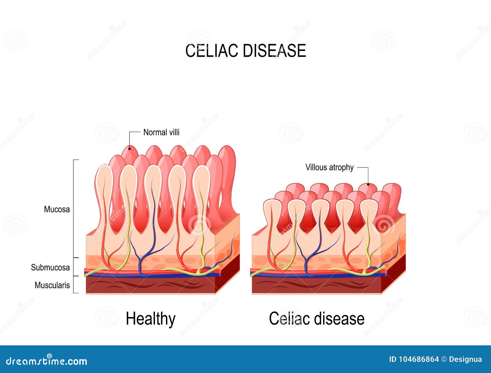 La Maladie Coeliaque Maladie Coeliaque Illustration de Vecteur ...