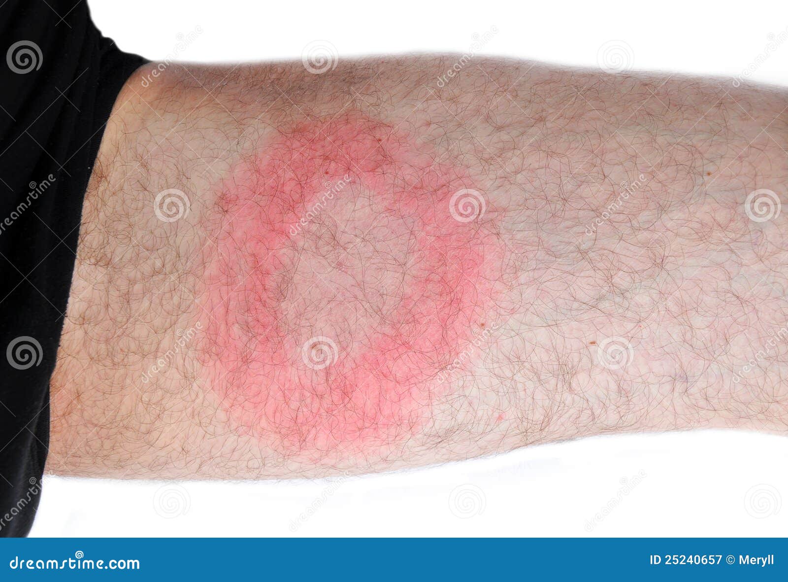 La Maladie De Lyme, Infection Bactérienne Image stock - Image du patte ...