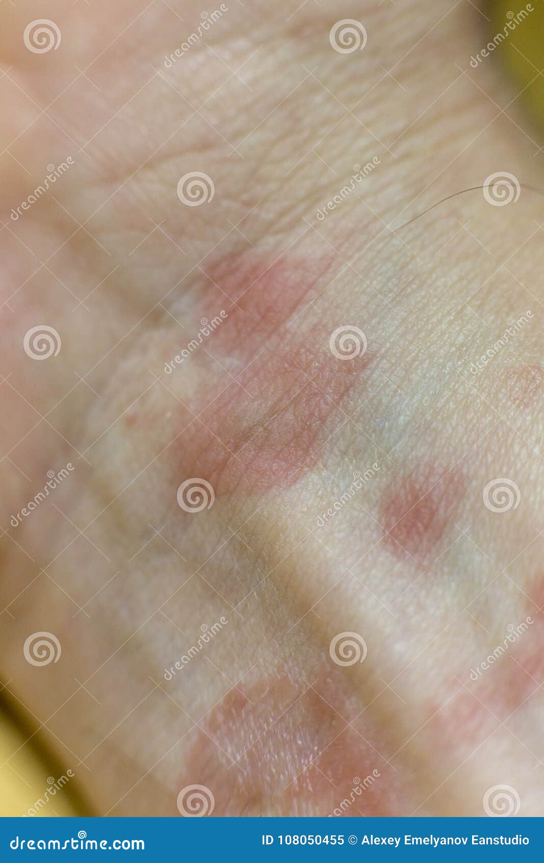La Maladie De La Peau Sur La Dermatite De Mains Image stock - Image du ...