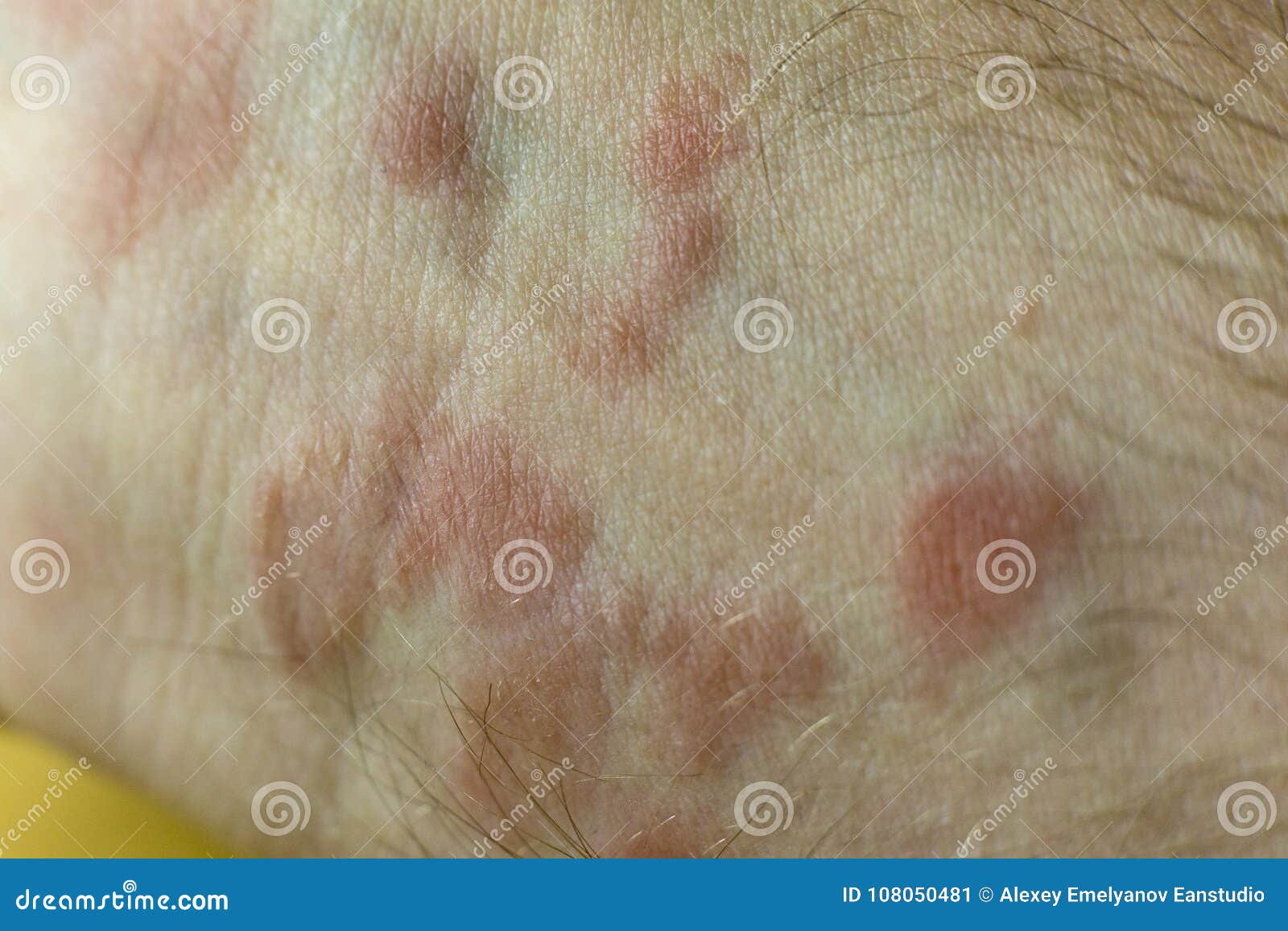 La Maladie De La Peau Sur La Dermatite De Mains Image stock - Image of ...