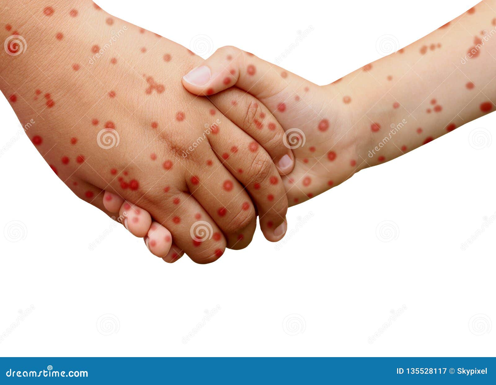 Images Rougeole - Téléchargez 1,732 Photos libres de droits