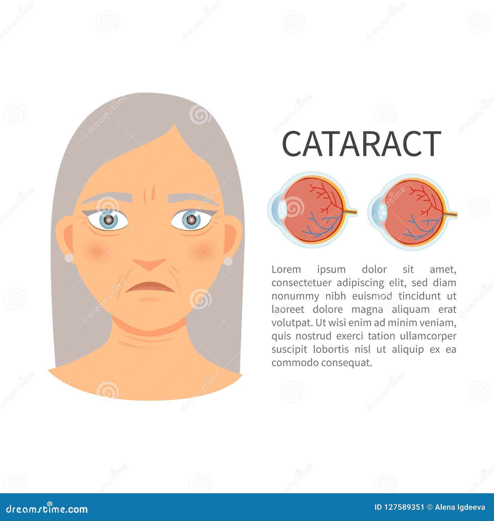 La Maladie De Yeux D'Infografica Illustration Stock - Illustration of ...