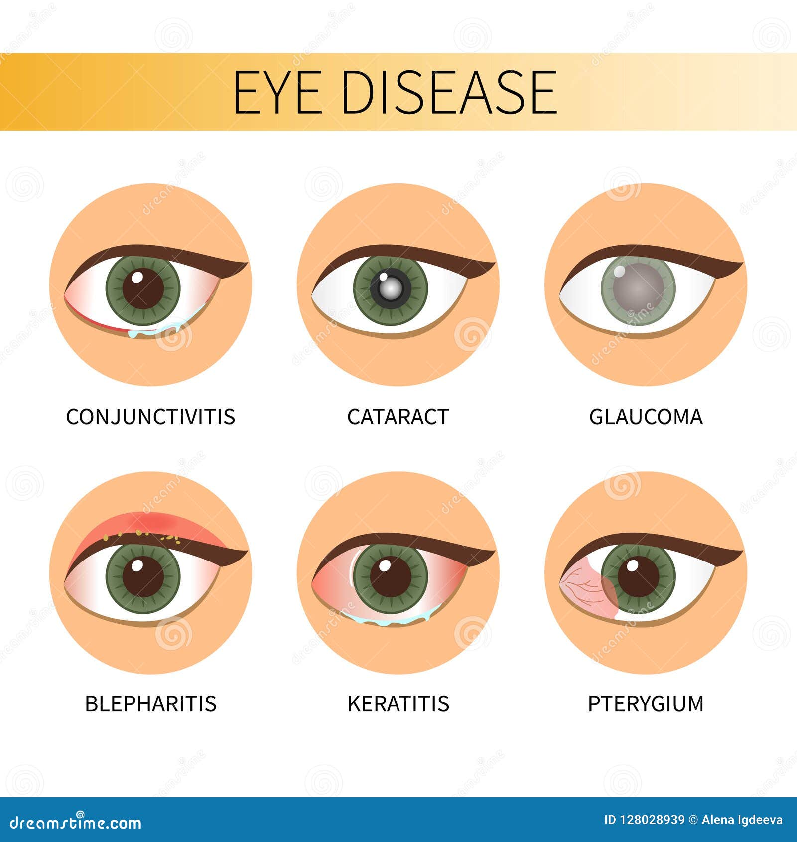 La Maladie De Yeux D'Infographic Illustration de Vecteur - Illustration ...