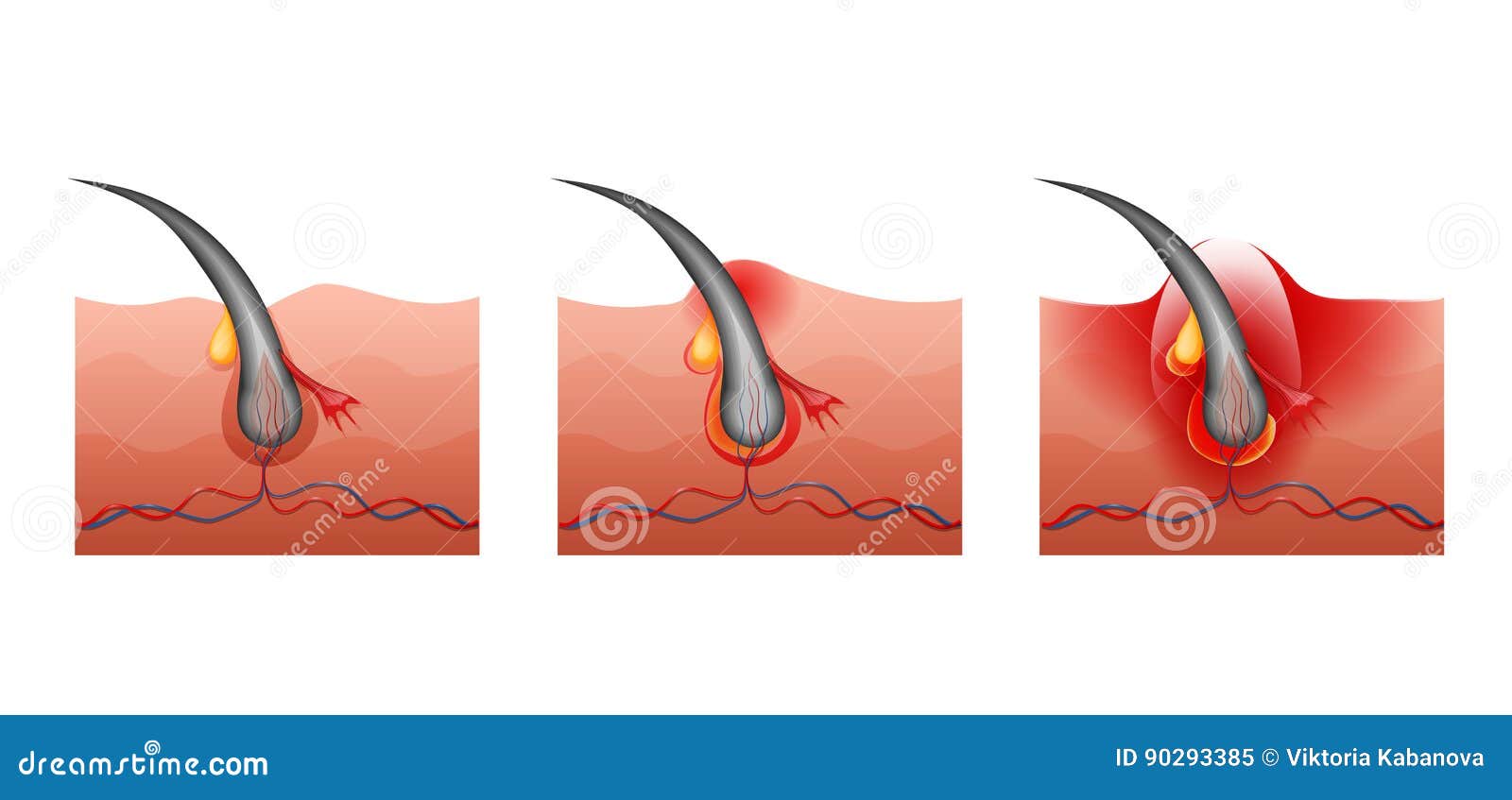 La maturazione del brufolo illustrazione vettoriale. Illustrazione di ...