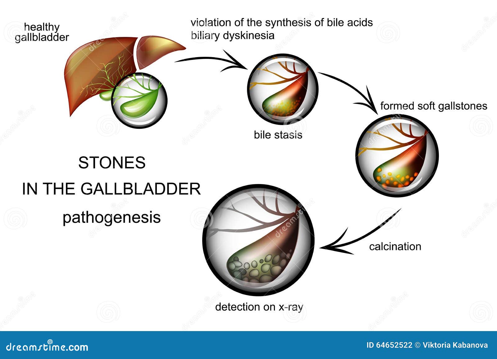 La Patogenesi Delle Colelitiasi Illustrazione Vettoriale ...