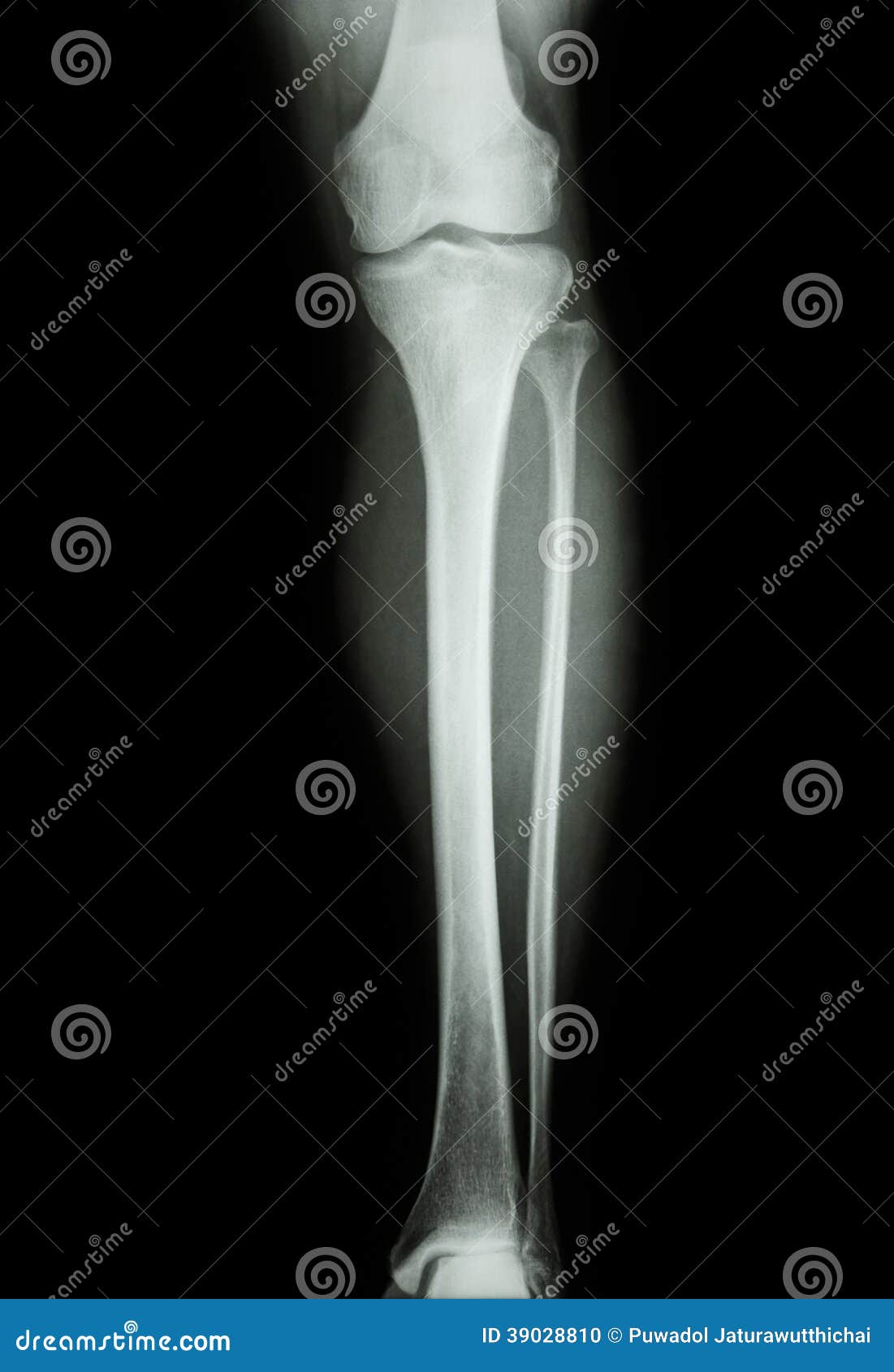 La Pierna Normal Del Ser Humano Foto de archivo - Imagen de hospital ...