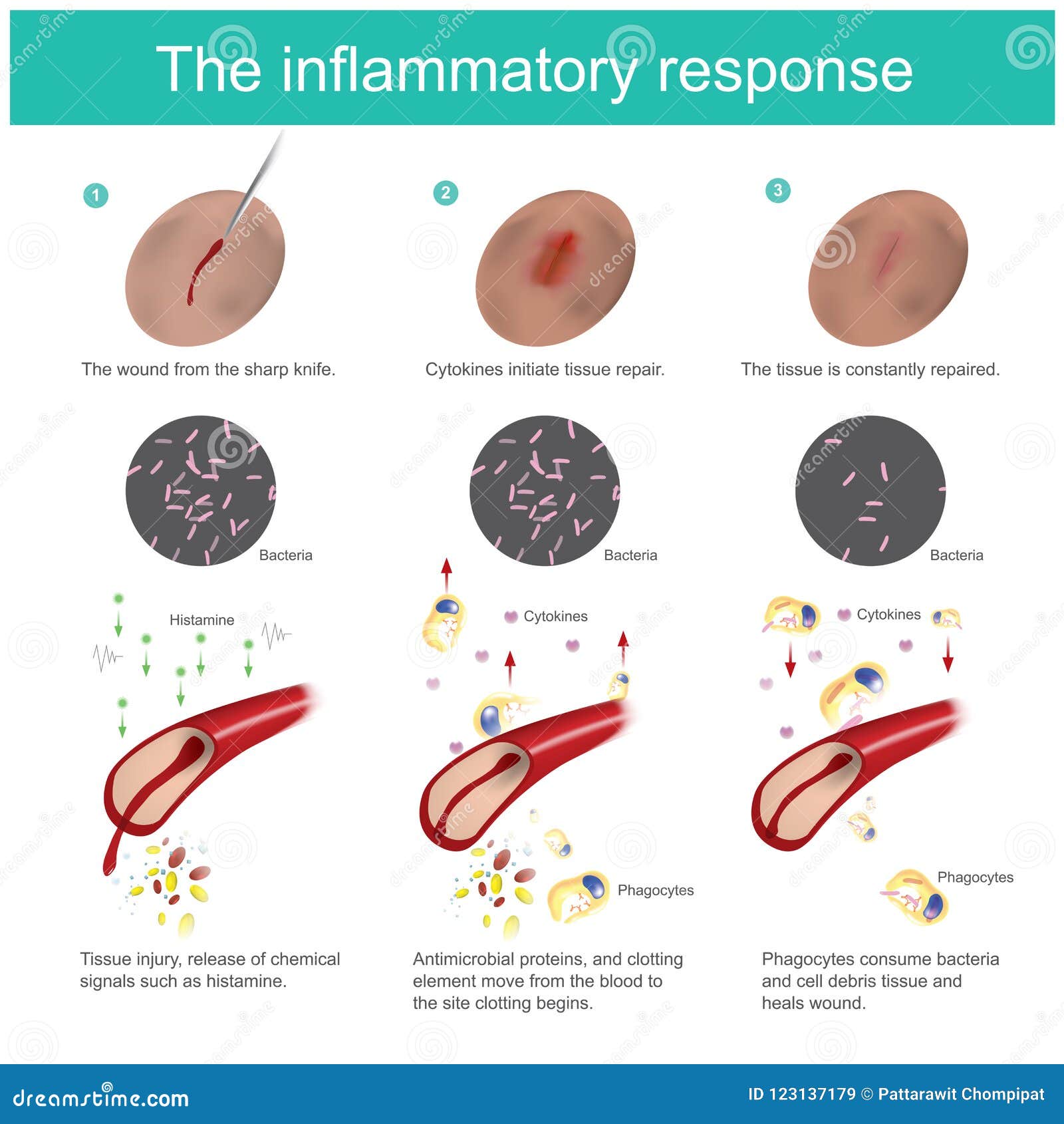 La risposta infiammatoria illustrazione vettoriale. Illustrazione di immunologia - 123137179