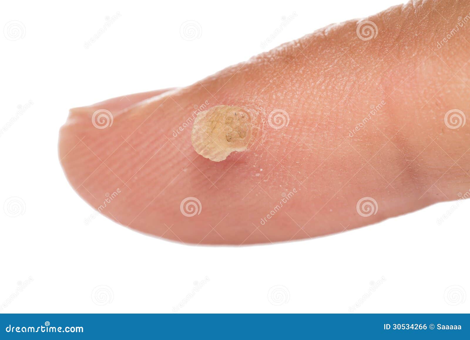 Laatste stadium van wrat stock foto. Image of schil, vernietiging ...