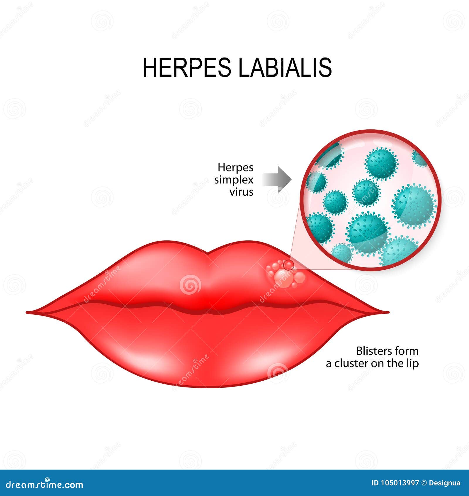 Labialis Del Herpes En Los Labios Ilustración del Vector - Ilustración ...