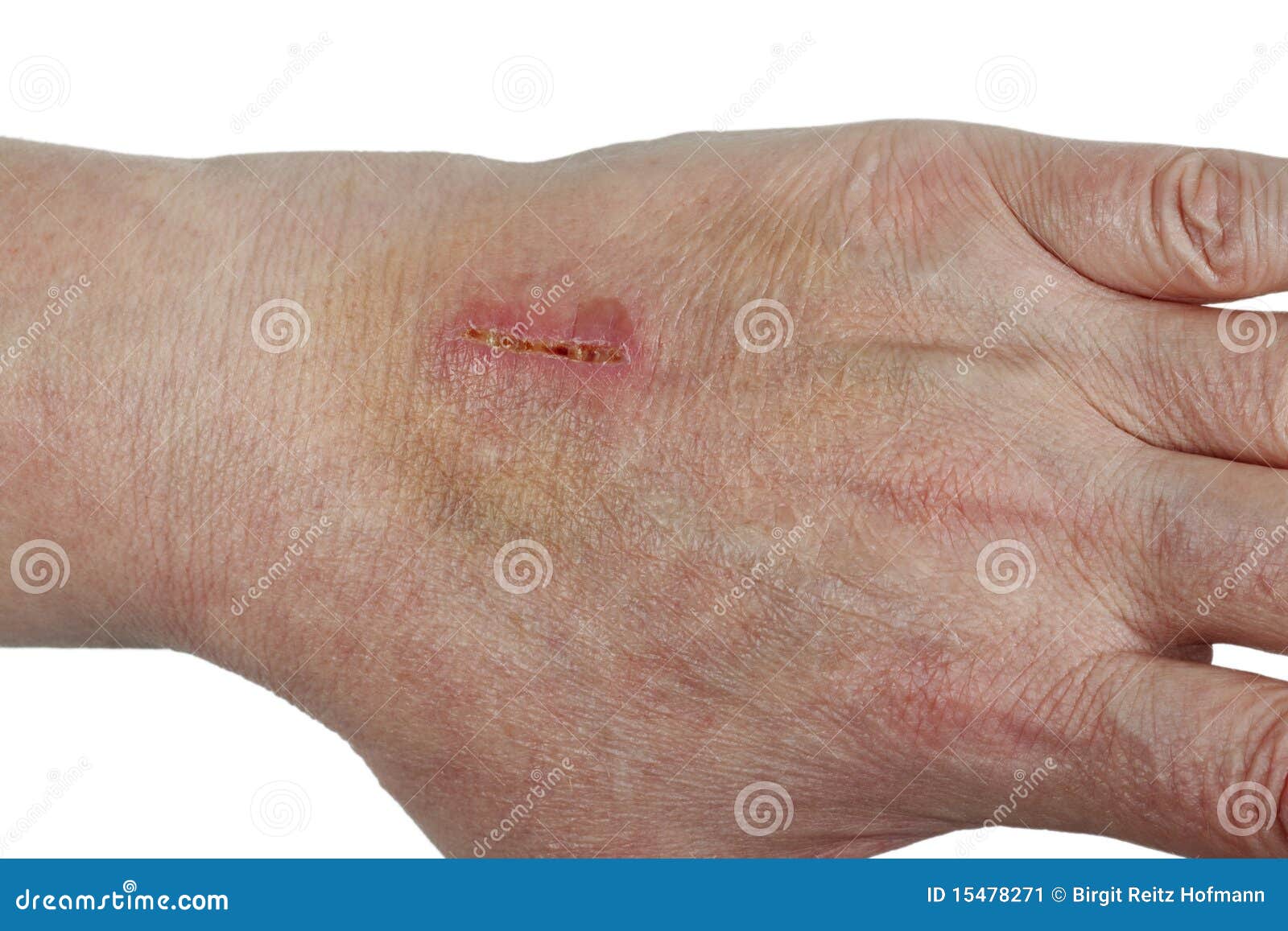 Laceration Stock Image - Image: 15478271