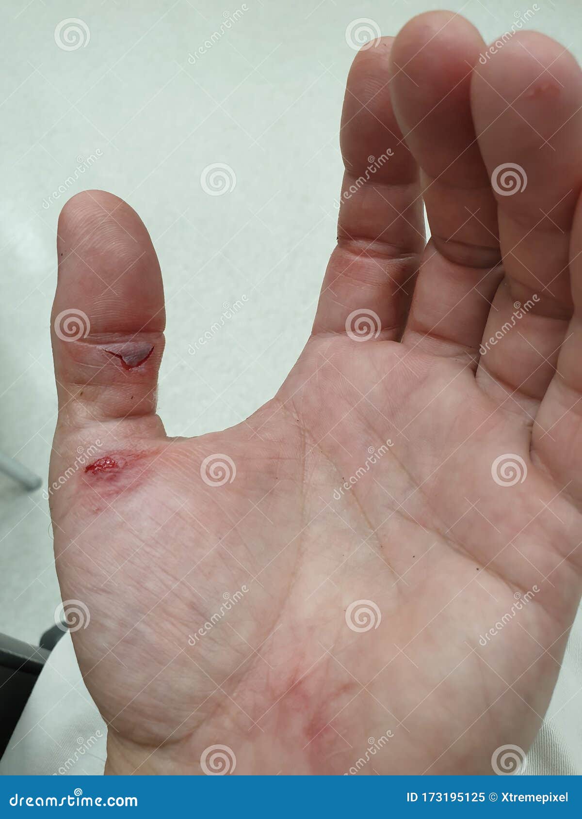 Lacerations on a hand stock image. Image of wound, bleed - 173195125
