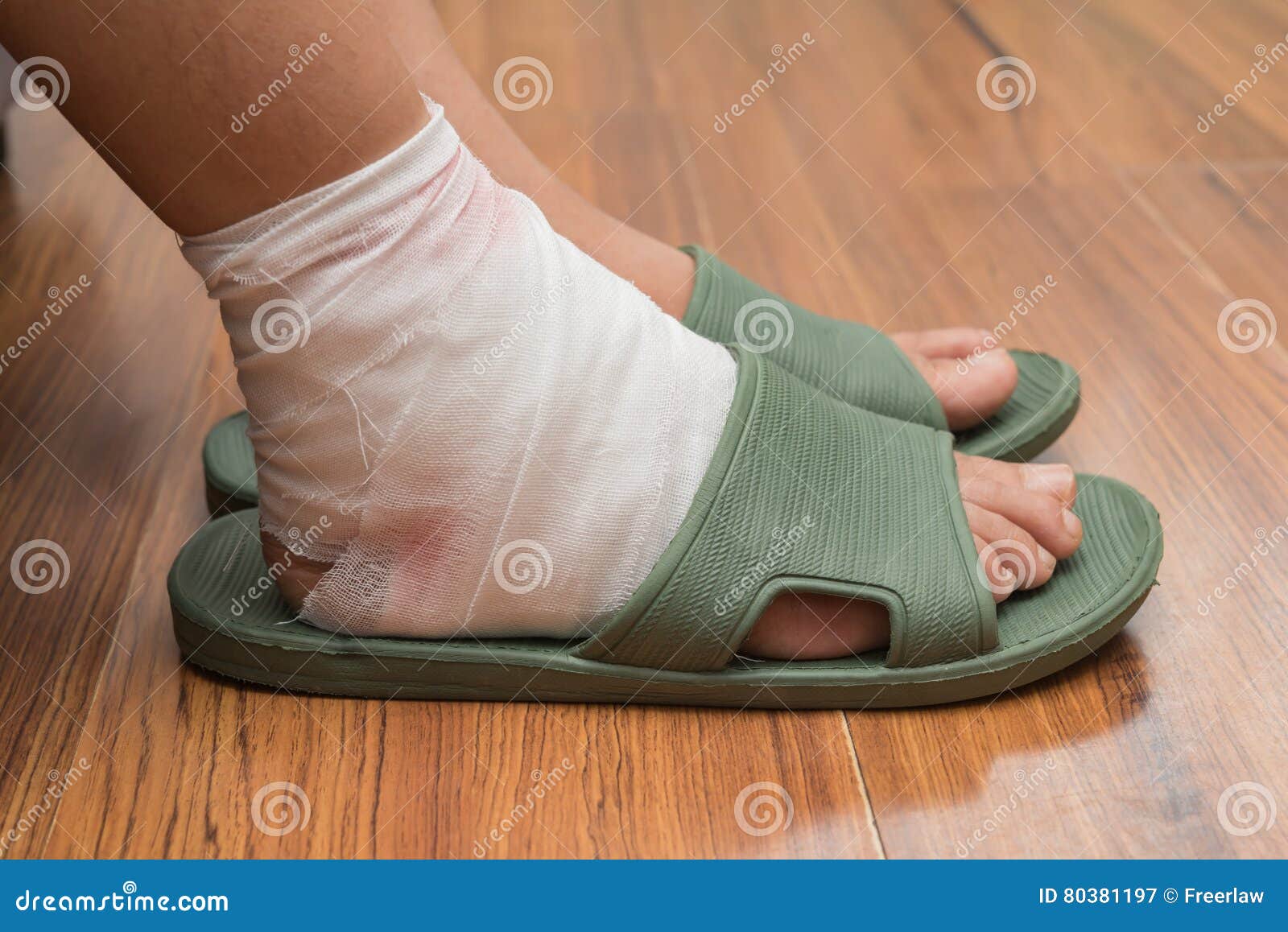 Lady with a wrapped foot stock image. Image of compensation - 80381197