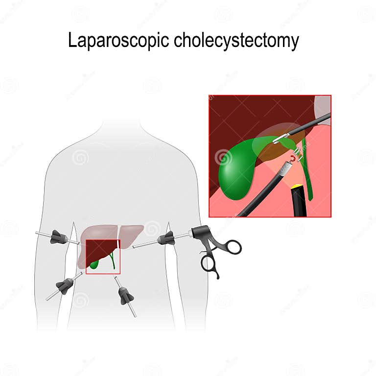 Laparoscopic Cholecystectomy Иллюстрация вектора - иллюстрации ...
