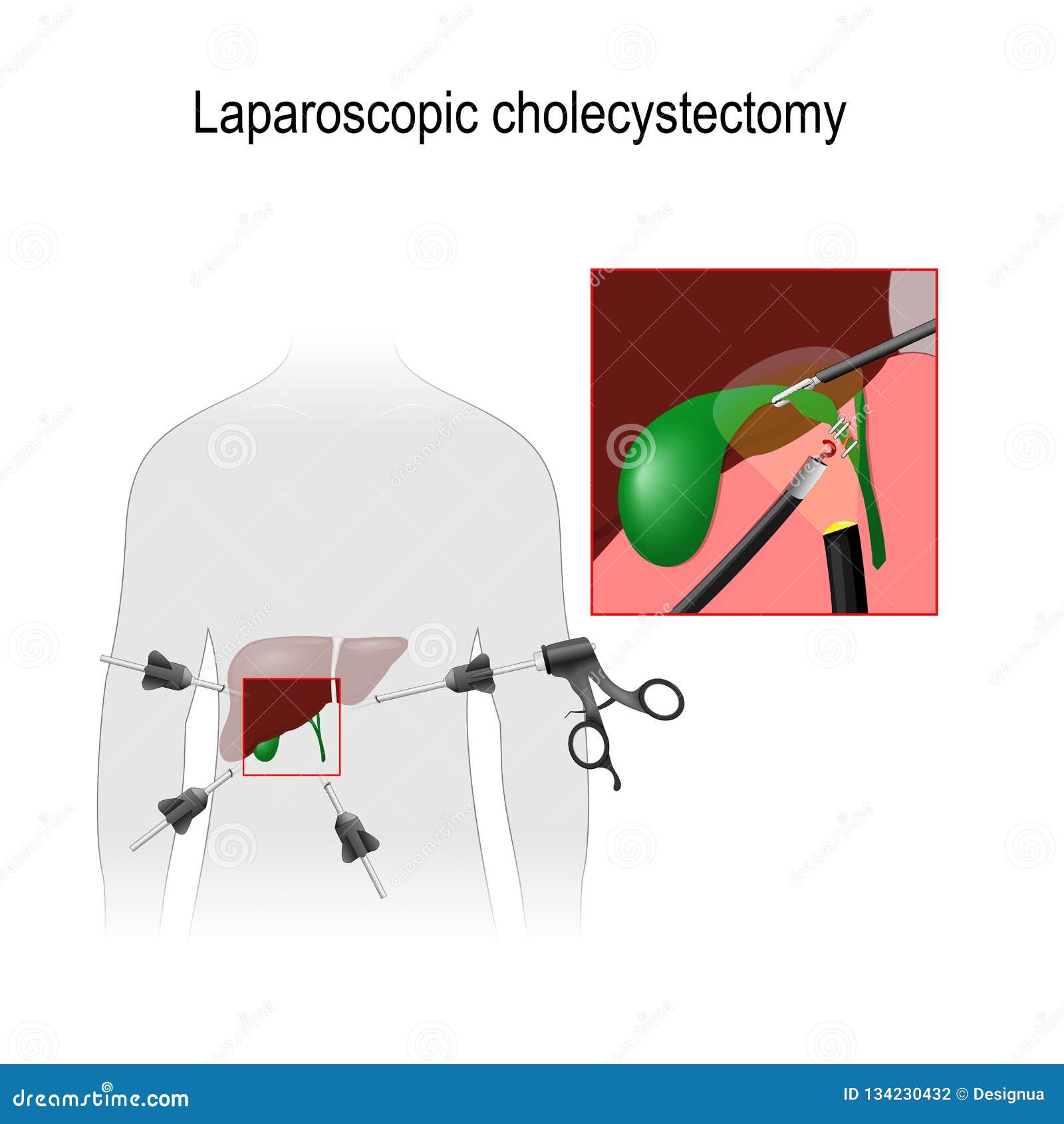 Laparoscopic Appendectomy - Appendix Removal Stock Illustration ... Laparoscopic Appendectomy - Appendix Removal Stock Illustration ...