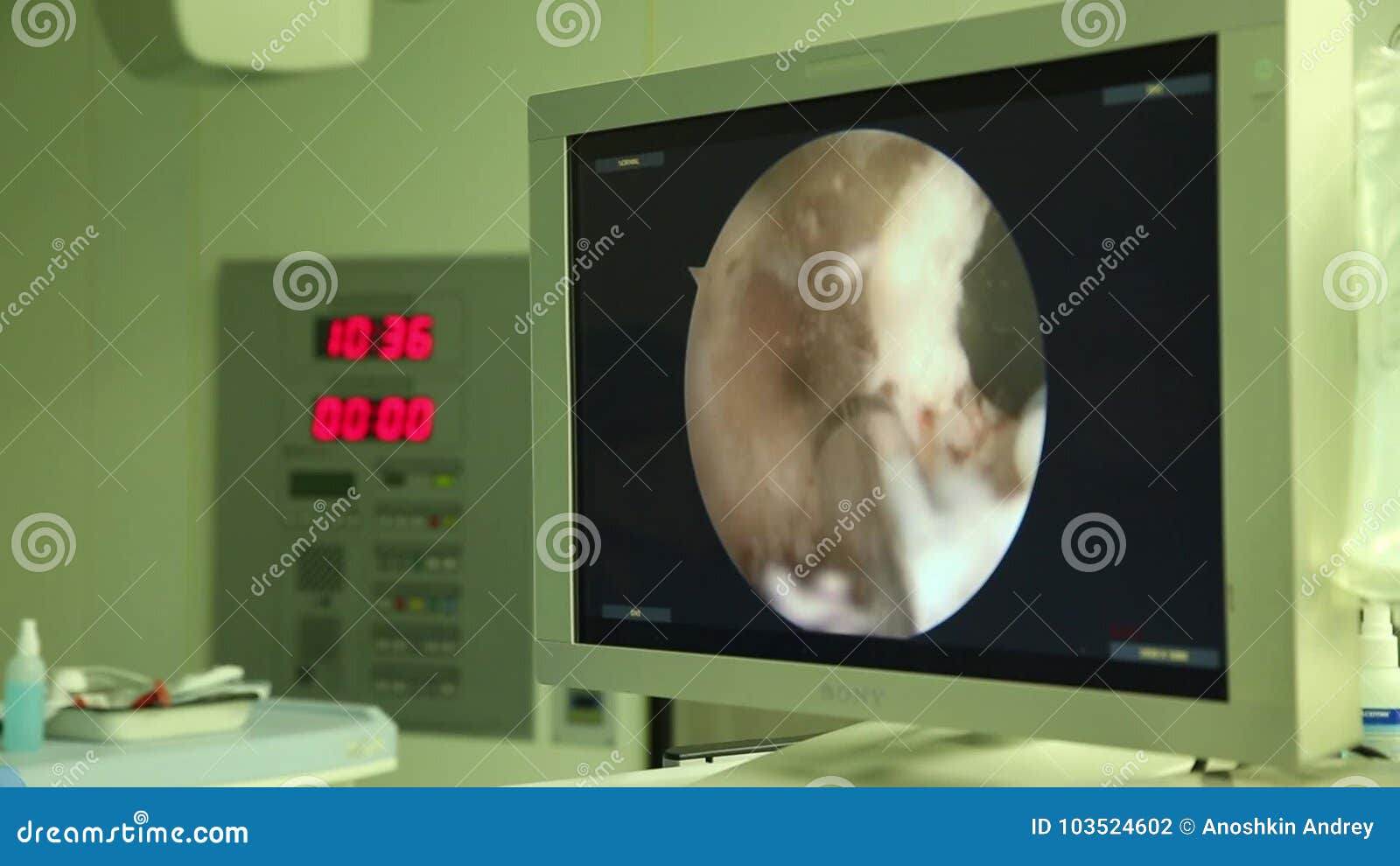 Laparoscopic operation. stock footage. Video of surgeon - 103524602