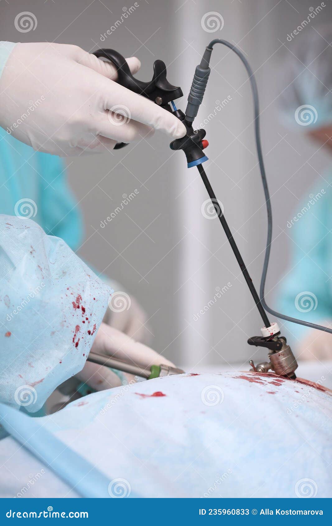 Laparoscopic Surgery. Operation Under General Anesthesia. Vertical ...