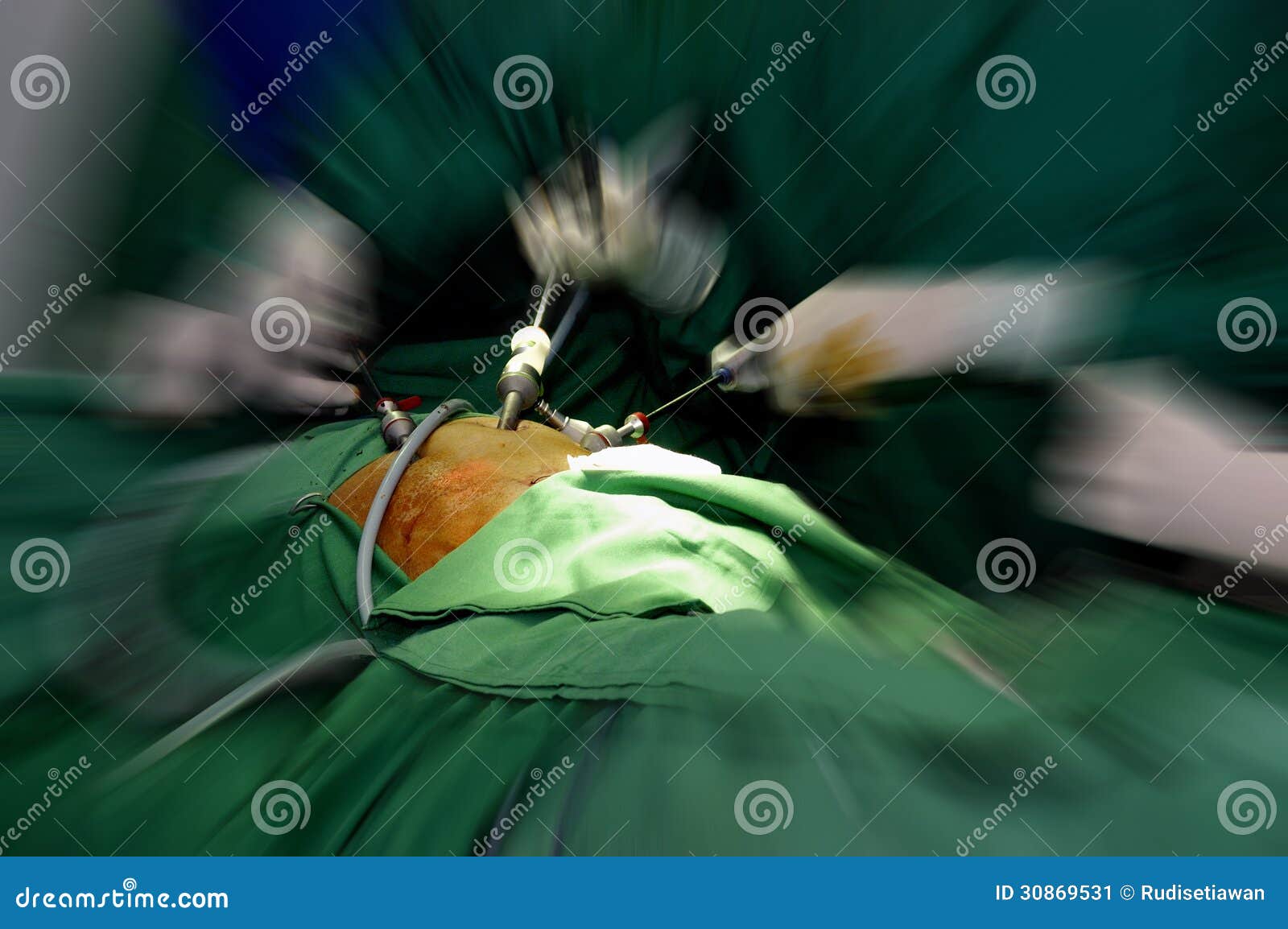 Laparoscopic surgery stock image. Image of procedure - 30869531
