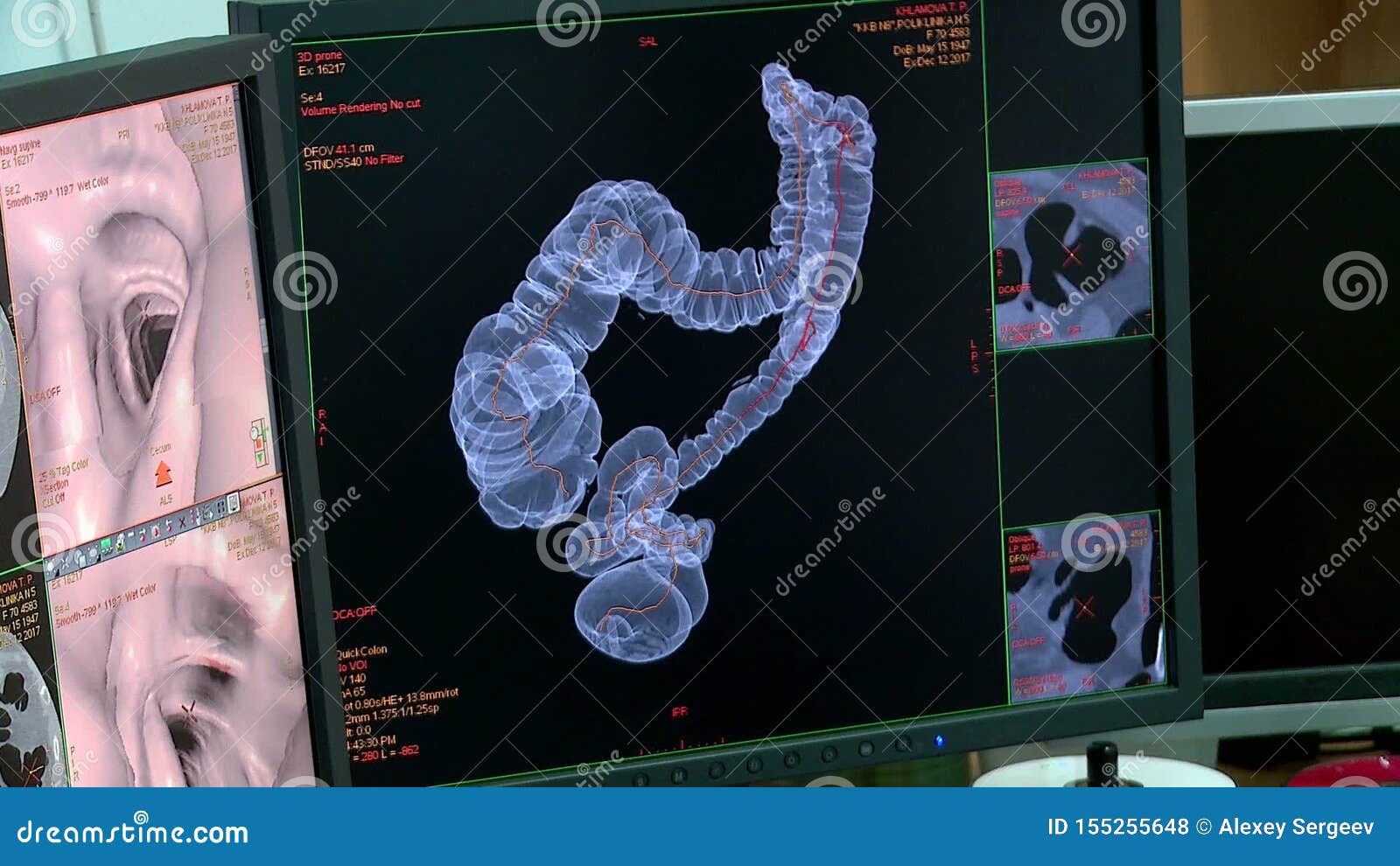 Laparoscopic Visualization Stock Footage & Videos - 3 Stock Videos