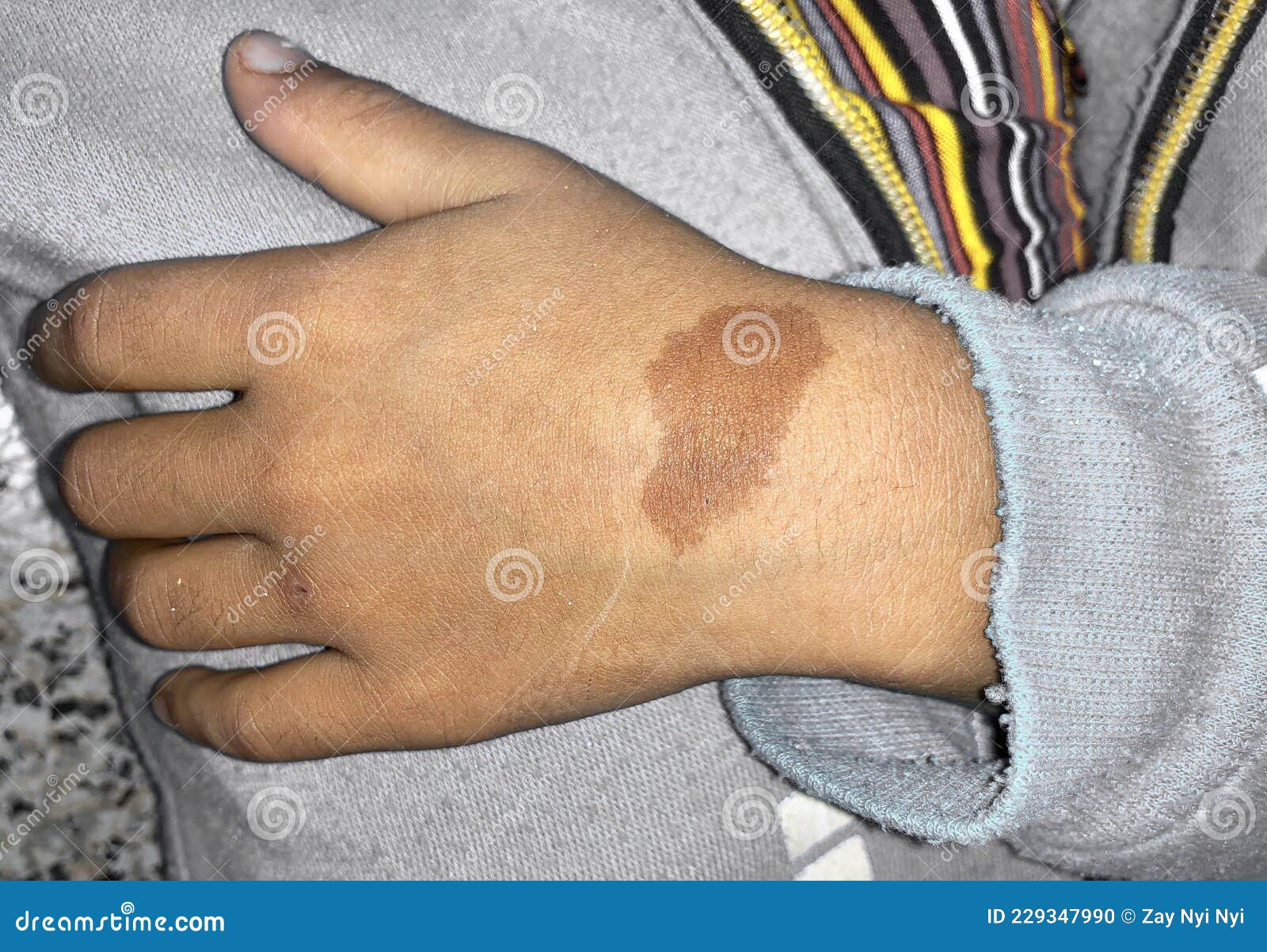 Large Birthmark with Irregular Shape on Hand. Dark Colored Patch Stock ...