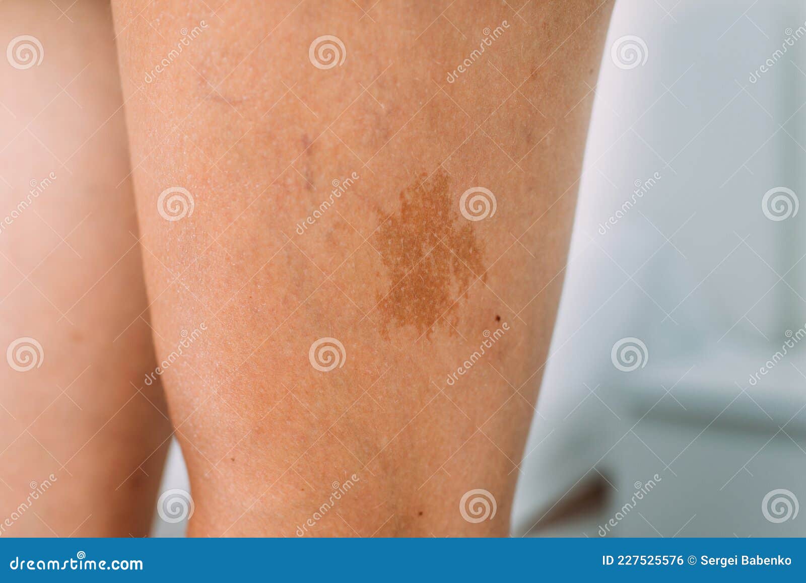 Large Birthmark on the Leg of a Caucasian Person Stock Photo - Image of ...