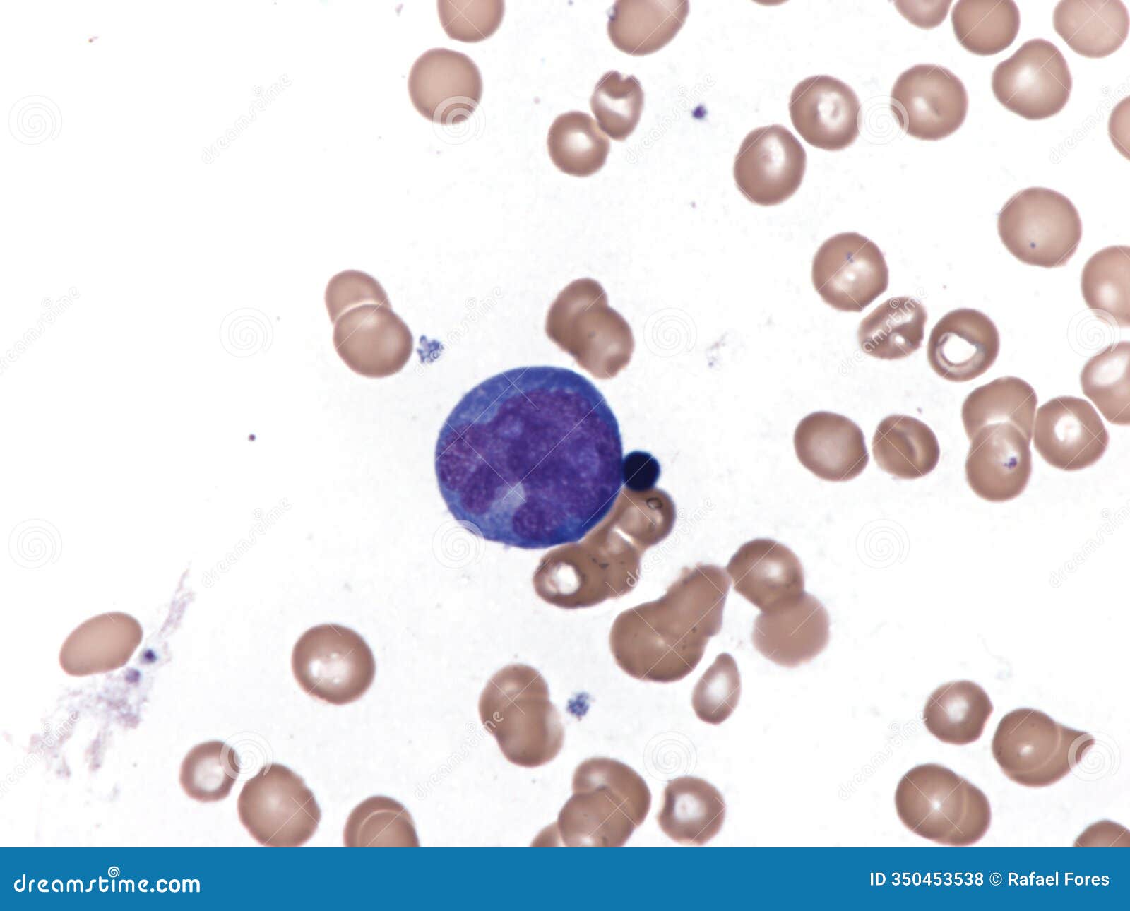 Blast Cell in Acute Myeloid Leukemia. Stock Photo - Image of clinical ...
