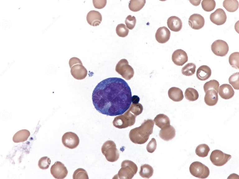 Blast Cell in Acute Myeloid Leukemia. Stock Photo - Image of clinical ...