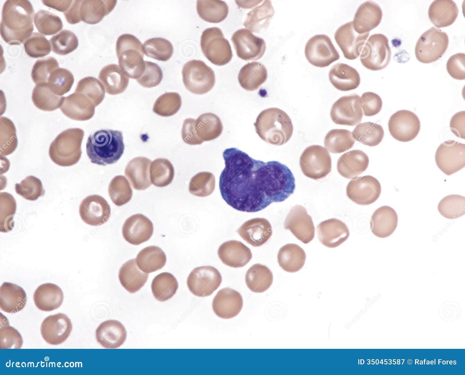 Acute Myeloid Leukemia. Peripheral Blood. Stock Image | CartoonDealer ...