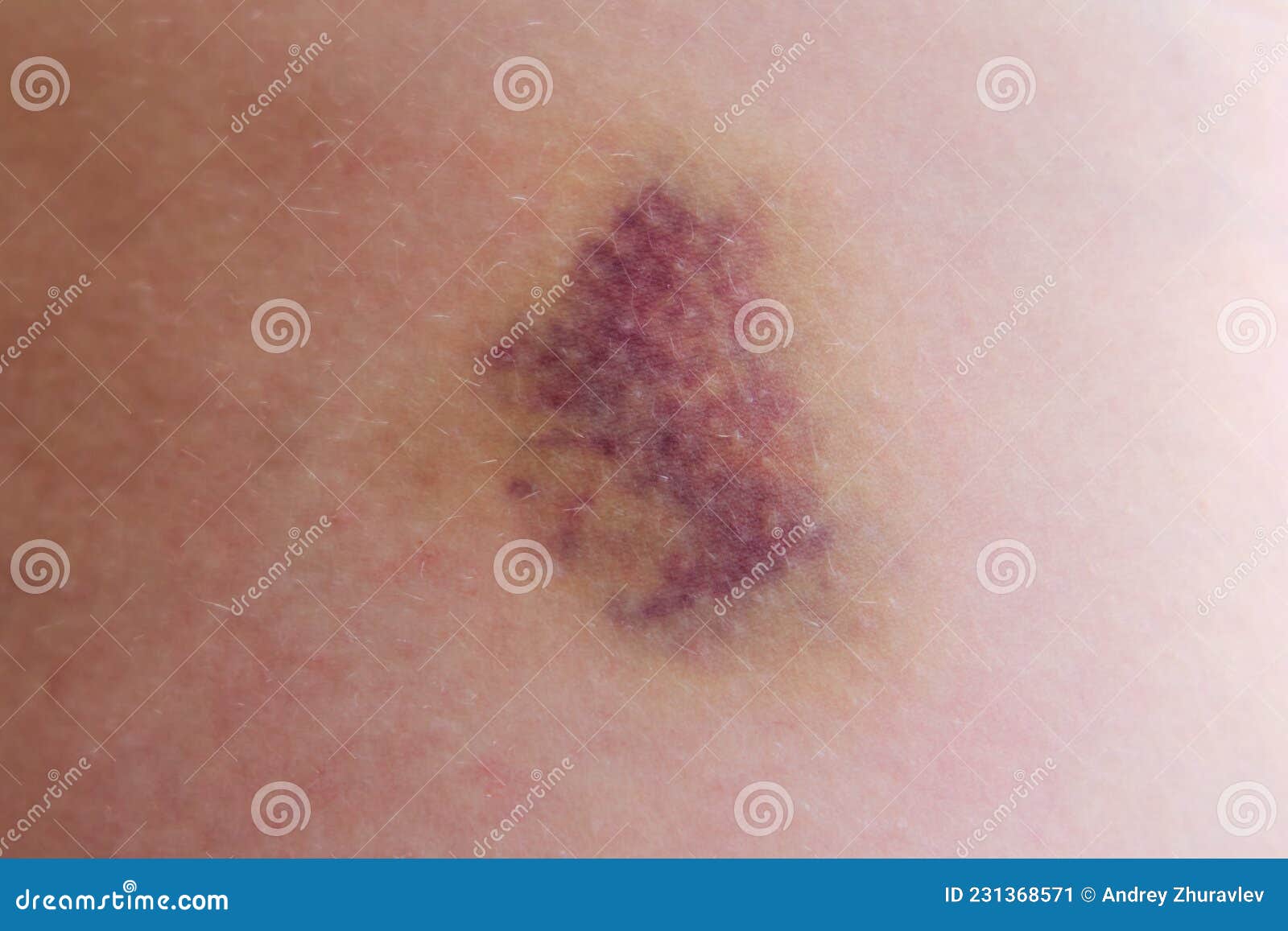 Large Bruise on the Human Body, Close Up Stock Image - Image of health ...