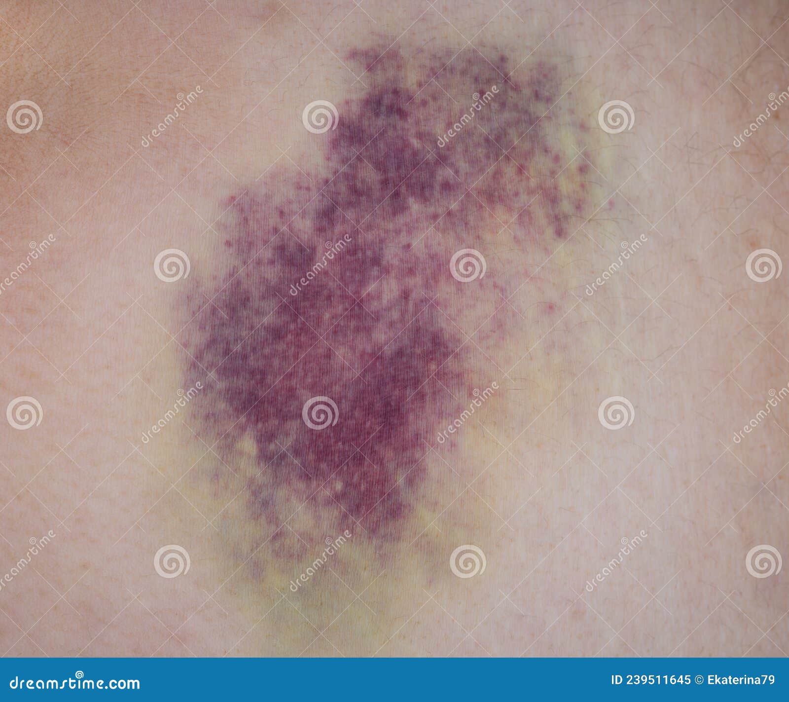 Large Bruise Hematoma On The Humans Leg On The Skin In Different Colors ...