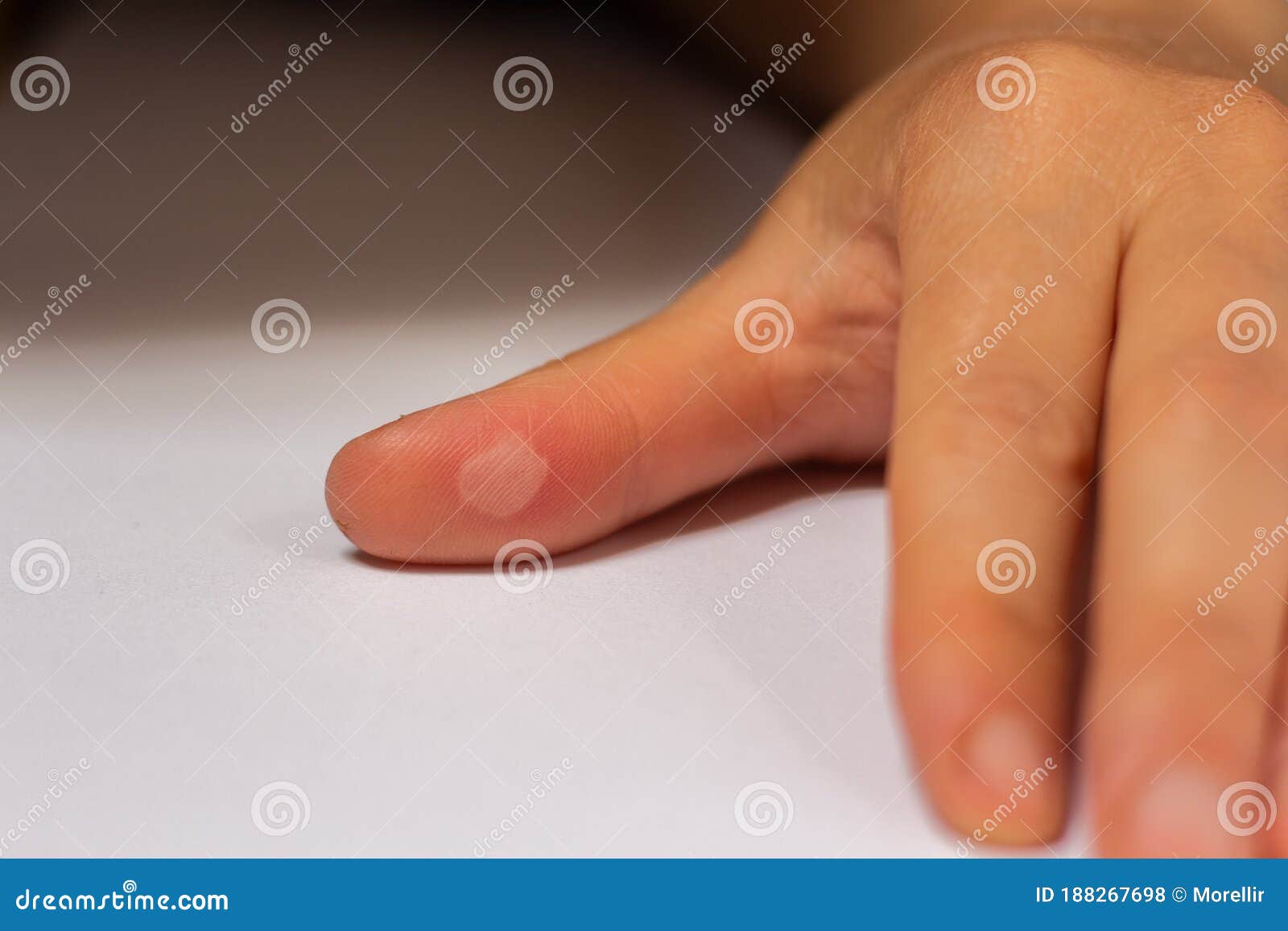 Large Bubble on the Woman& X27;s Hand Caused by a Rub Stock Photo ...