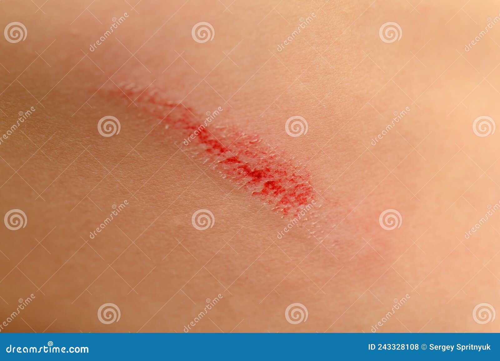 Large Cut on the Leg. Skin Abrasion Stock Photo - Image of forehead ...