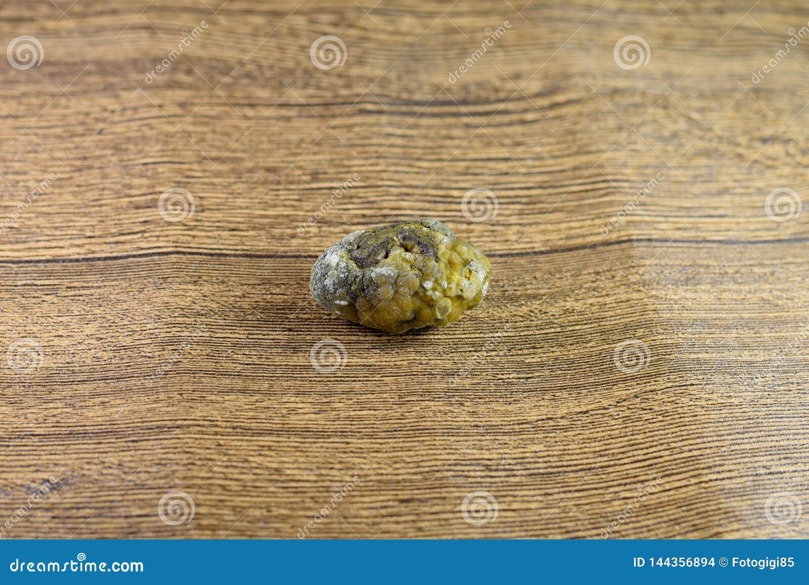 Large Gallstone, Gall Bladder Stone. Result of Gallstones. Calculus of ...