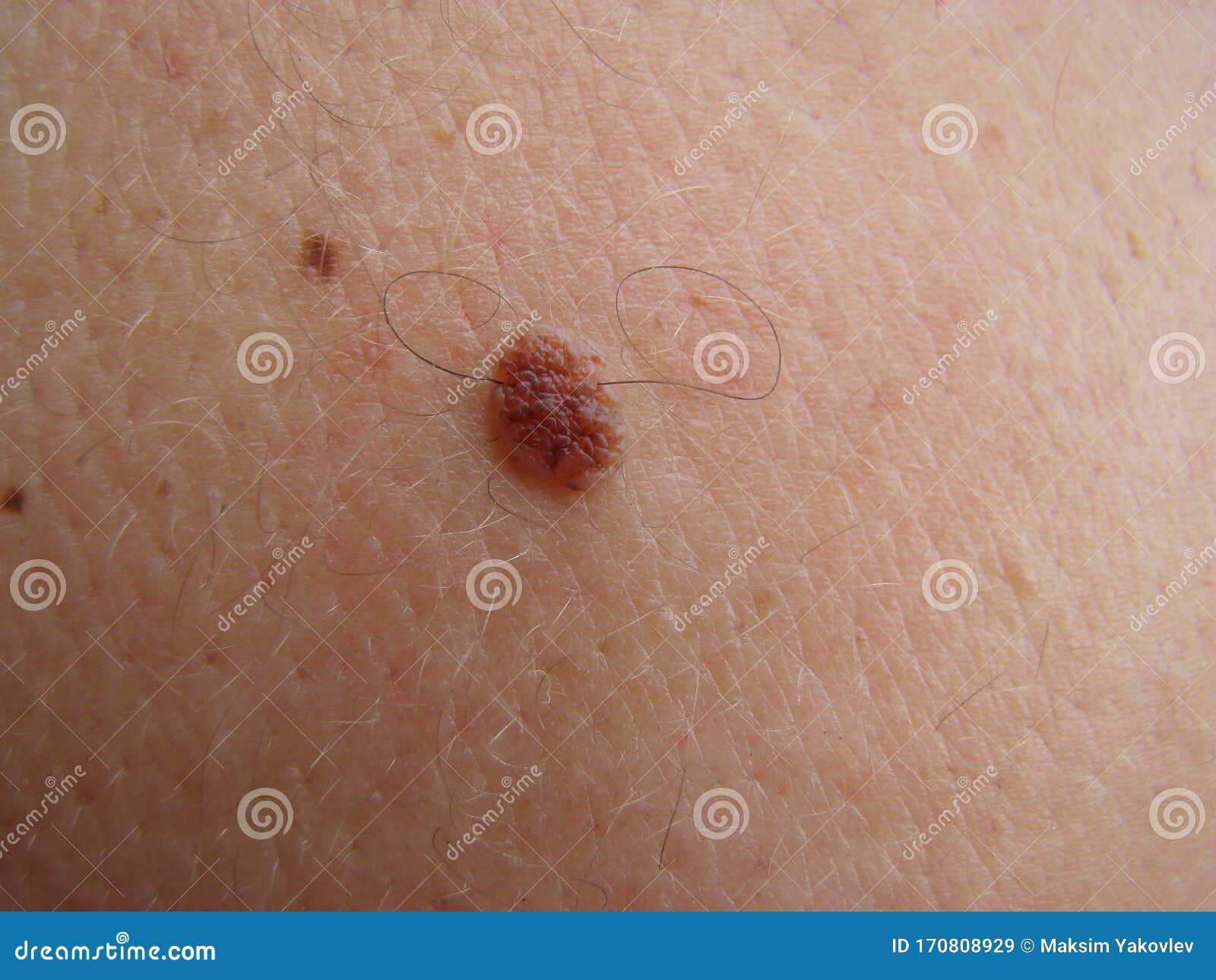 Nevus stock image. Image of large, health, wart, growth - 170808929