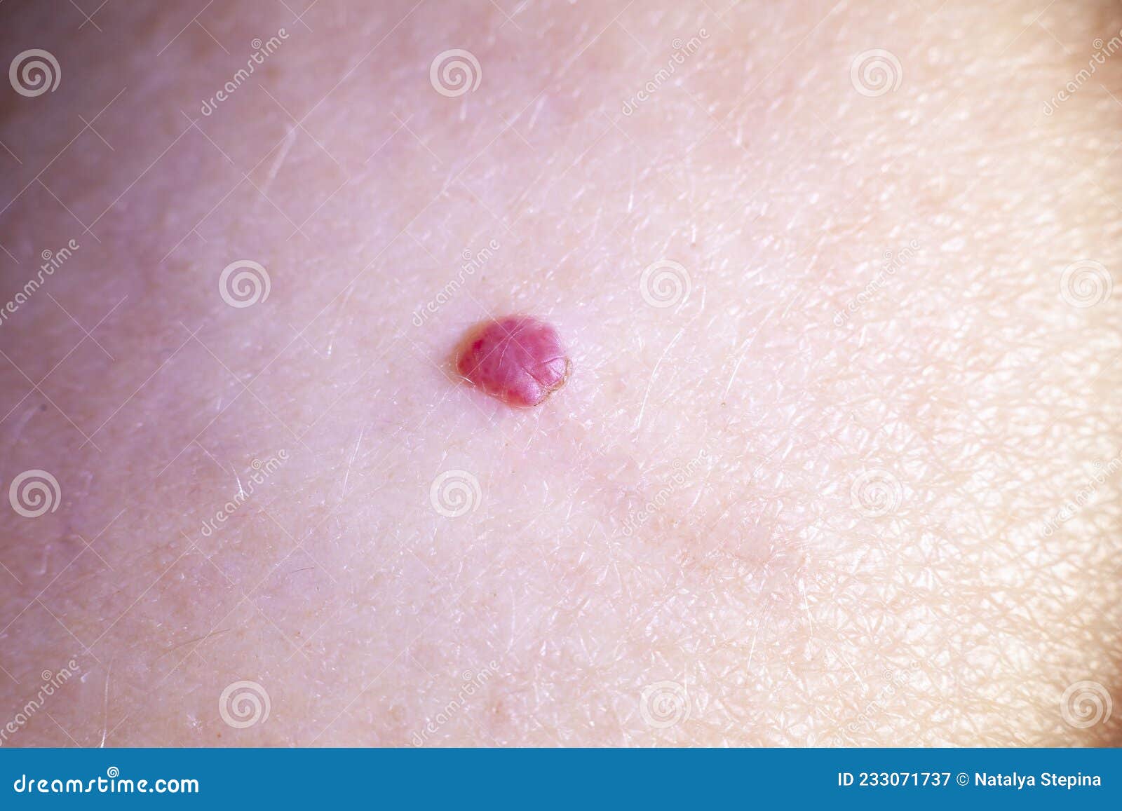 A Large Red Mole On Human Skin Macro Stock Image Image Of Healthcare