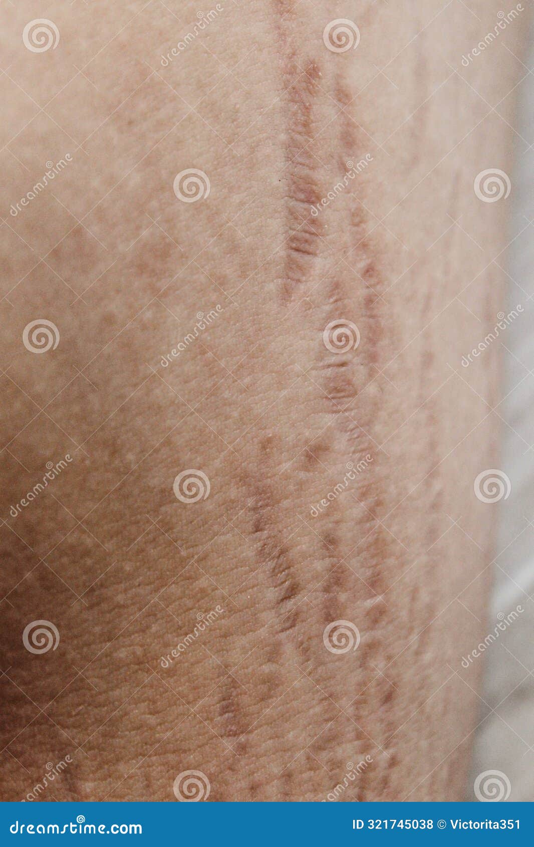 Large Stretch Marks on the Body Close-up Stock Photo - Image of ...