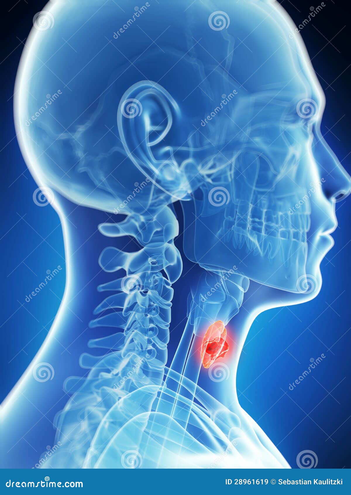 Laringe maschio - cancro illustrazione di stock. Illustrazione di ...