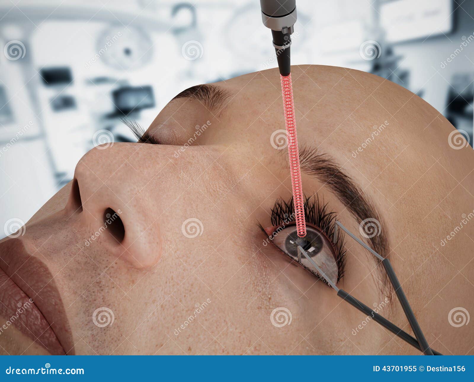 Laser Eye Surgery on 3D CGI Character Stock Image - Image of surgery ...